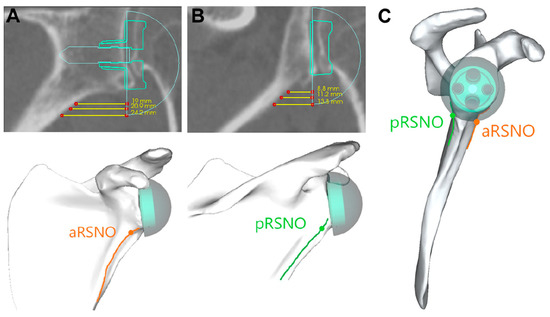 Challenges for Optimization of Reverse Shoulder Arthroplasty Part I ...
