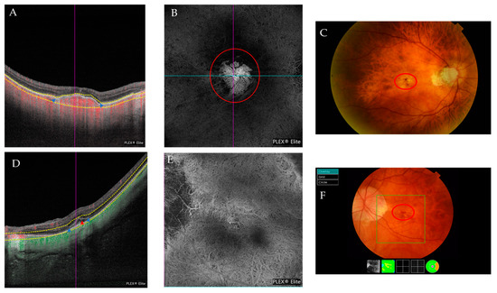 JCM | Free Full-Text | Does PLEX® Elite 9000 OCT Identify and ...