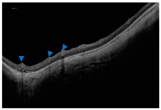 Does PLEX® Elite 9000 OCT Identify and Characterize Most Posterior Pole ...