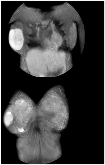 JCM | Free Full-Text | Giant Juvenile Fibroadenoma: Case Report and ...