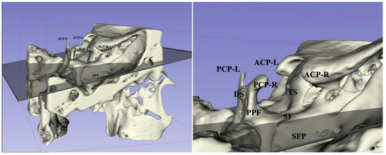 A CBCT Investigation of the Sella Turcica Dimension and Sella Turcica ...