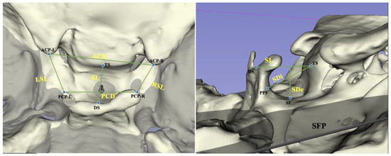 A CBCT Investigation of the Sella Turcica Dimension and Sella Turcica ...