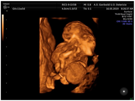 Body Stalk Anomaly Complicated by Ectopia Cordis: First-Trimester ...