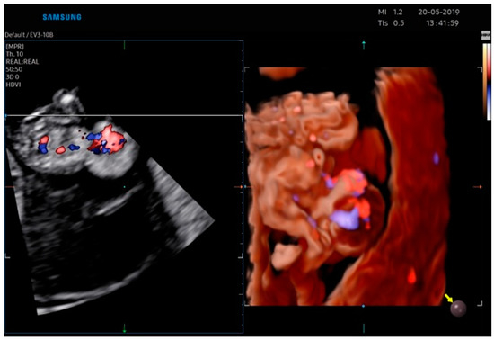 Body Stalk Anomaly Complicated by Ectopia Cordis: First-Trimester ...