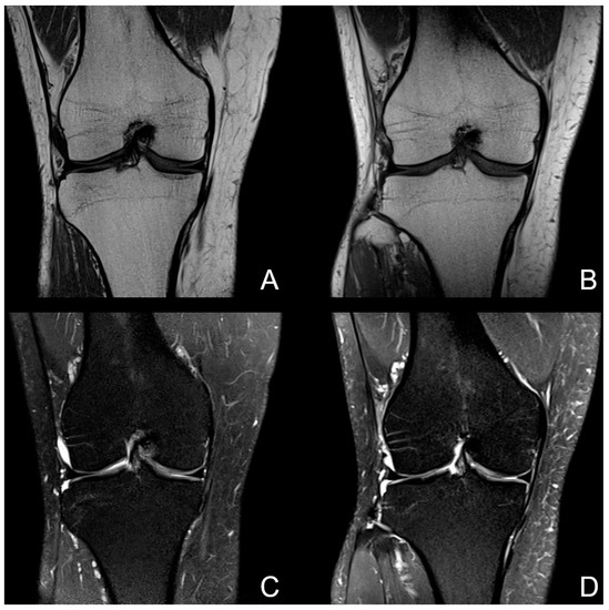 Diagnostic Image Quality Of A Low Field 0 55t Knee Mri Protocol Using Deep Learning Image