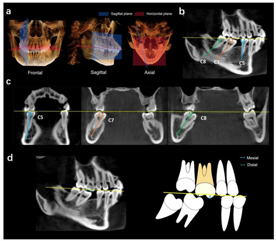 Characteristics of Spatial Changes in Molars and Alveolar Bone ...