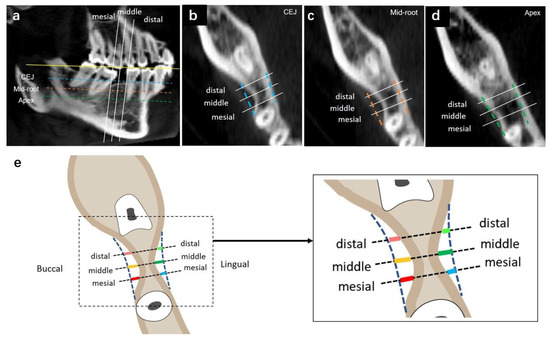 Characteristics of Spatial Changes in Molars and Alveolar Bone ...