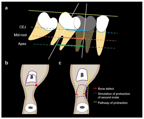 Characteristics of Spatial Changes in Molars and Alveolar Bone ...