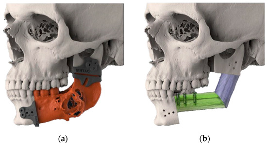 Accuracy Evaluation of an Alternative Approach for a CAD-AM Mandibular ...