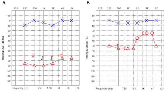 Is There an Association between Concurrent Epstein–Barr Virus Infection ...