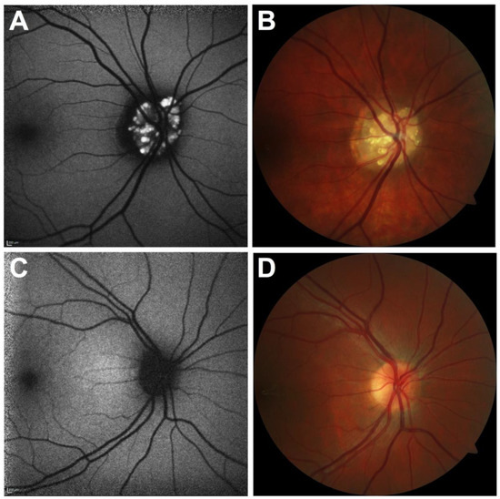 Discriminating Healthy Optic Discs and Visible Optic Disc Drusen on ...