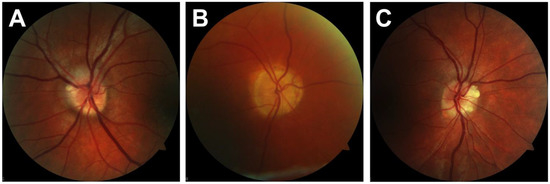 Discriminating Healthy Optic Discs and Visible Optic Disc Drusen on ...