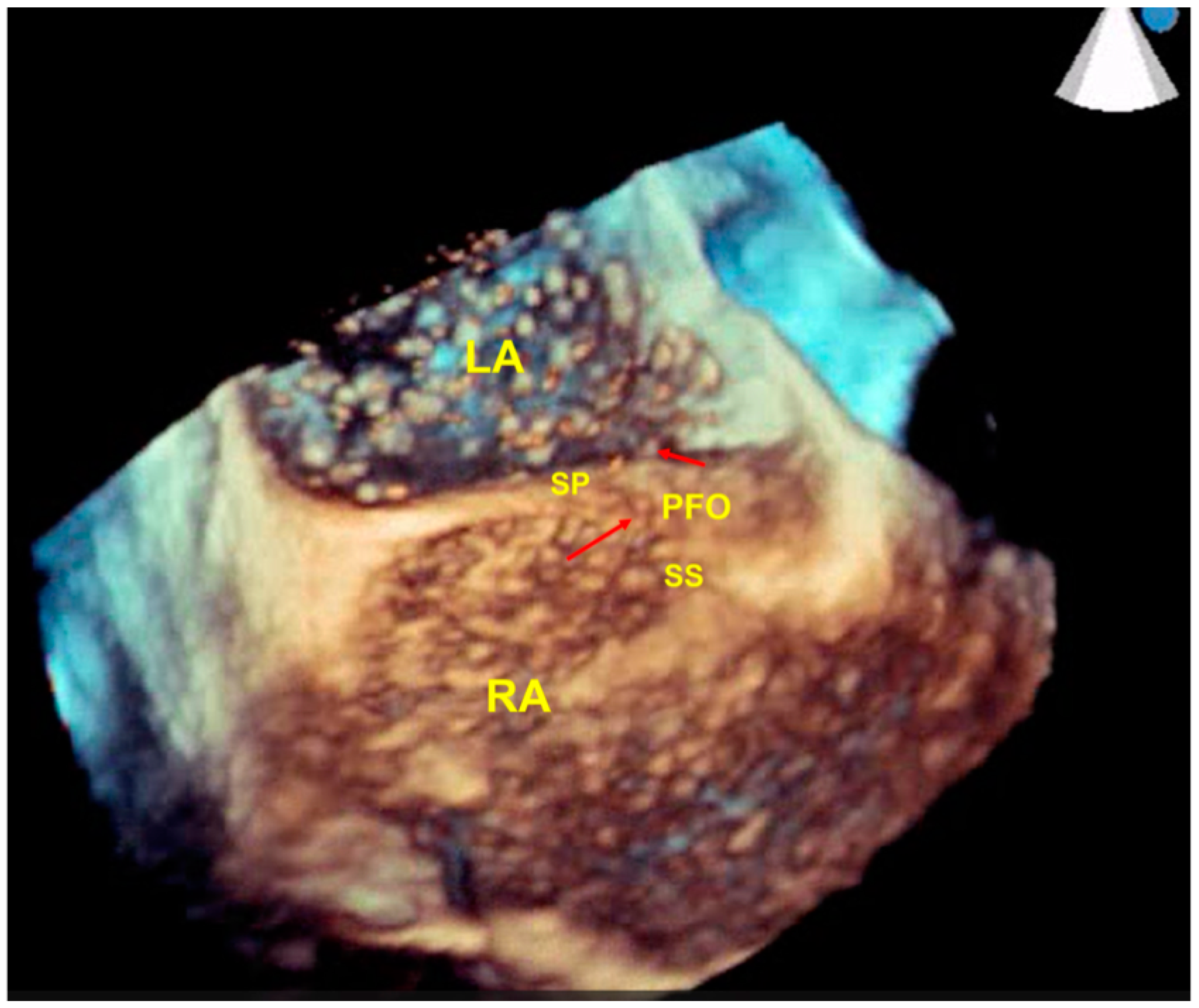 JCM | Free Full-Text | Patent Foramen Ovale and Cryptogenic Stroke ...
