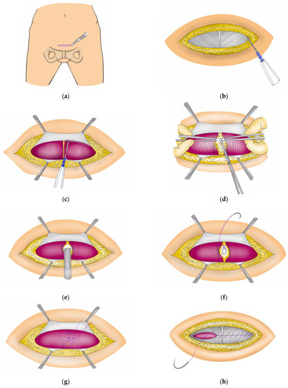 Role of the Pfannenstiel Incision in Robotic Hepato-Pancreato-Biliary ...