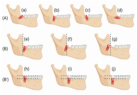 Comparison between the Flapless Surgical Approach and a Novel Single Incision Access in Terms of ...
