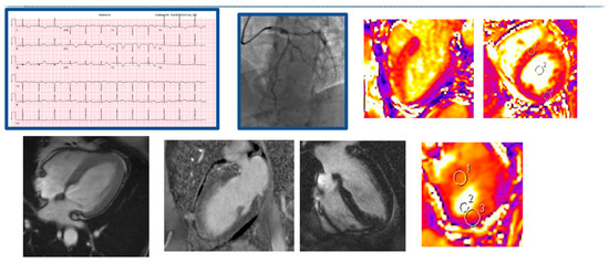 Role of Cardiac Magnetic Resonance Imaging in the Evaluation of MINOCA