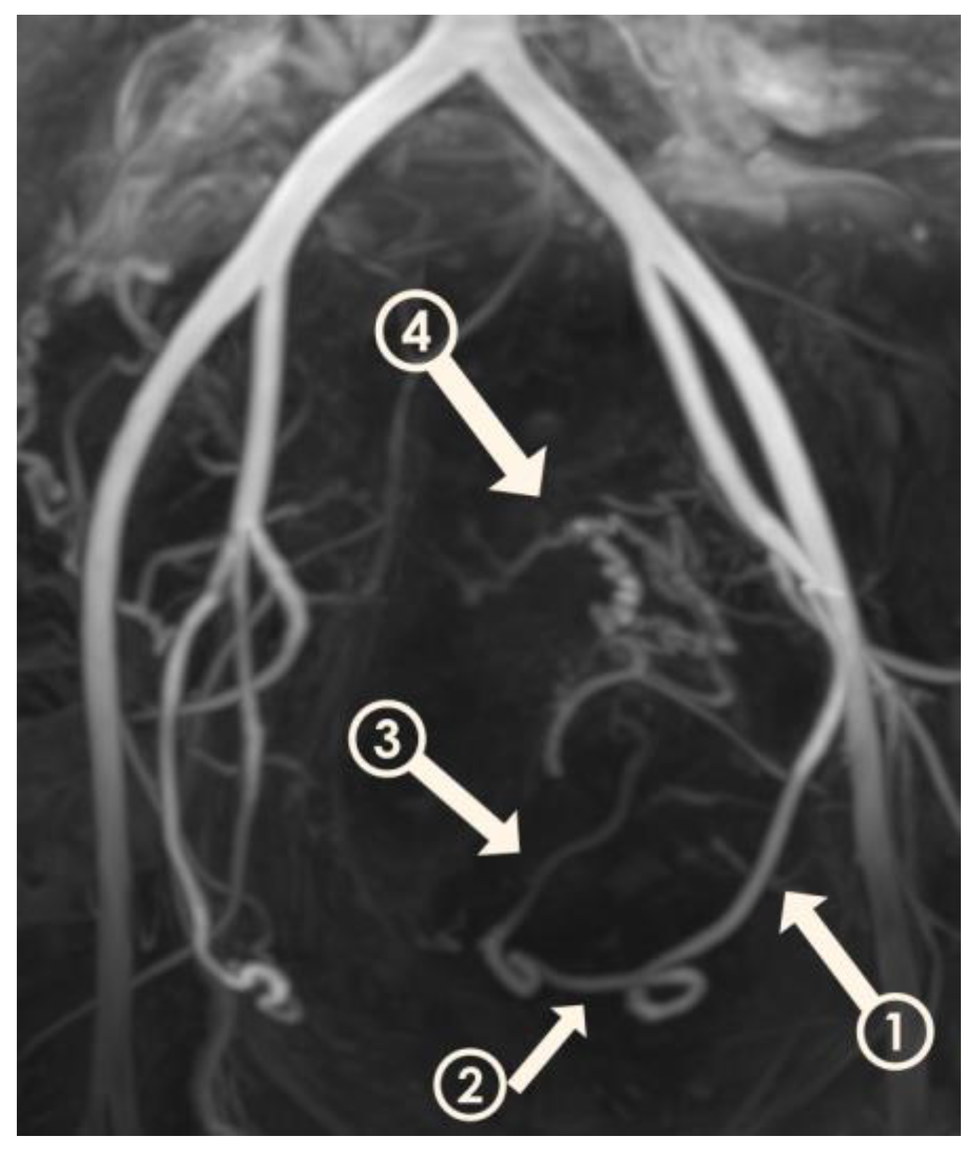 Use of Non-Contrast-Enhanced MR Angiography to Assess Recanalization ...