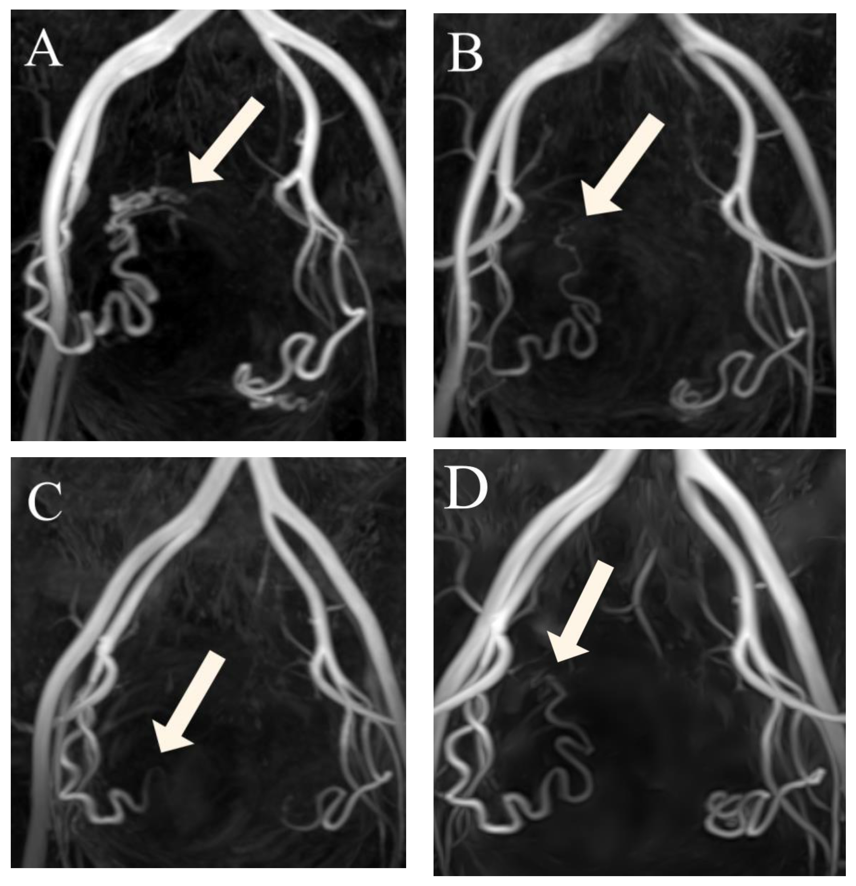 Use of Non-Contrast-Enhanced MR Angiography to Assess Recanalization after Uterine Artery ...