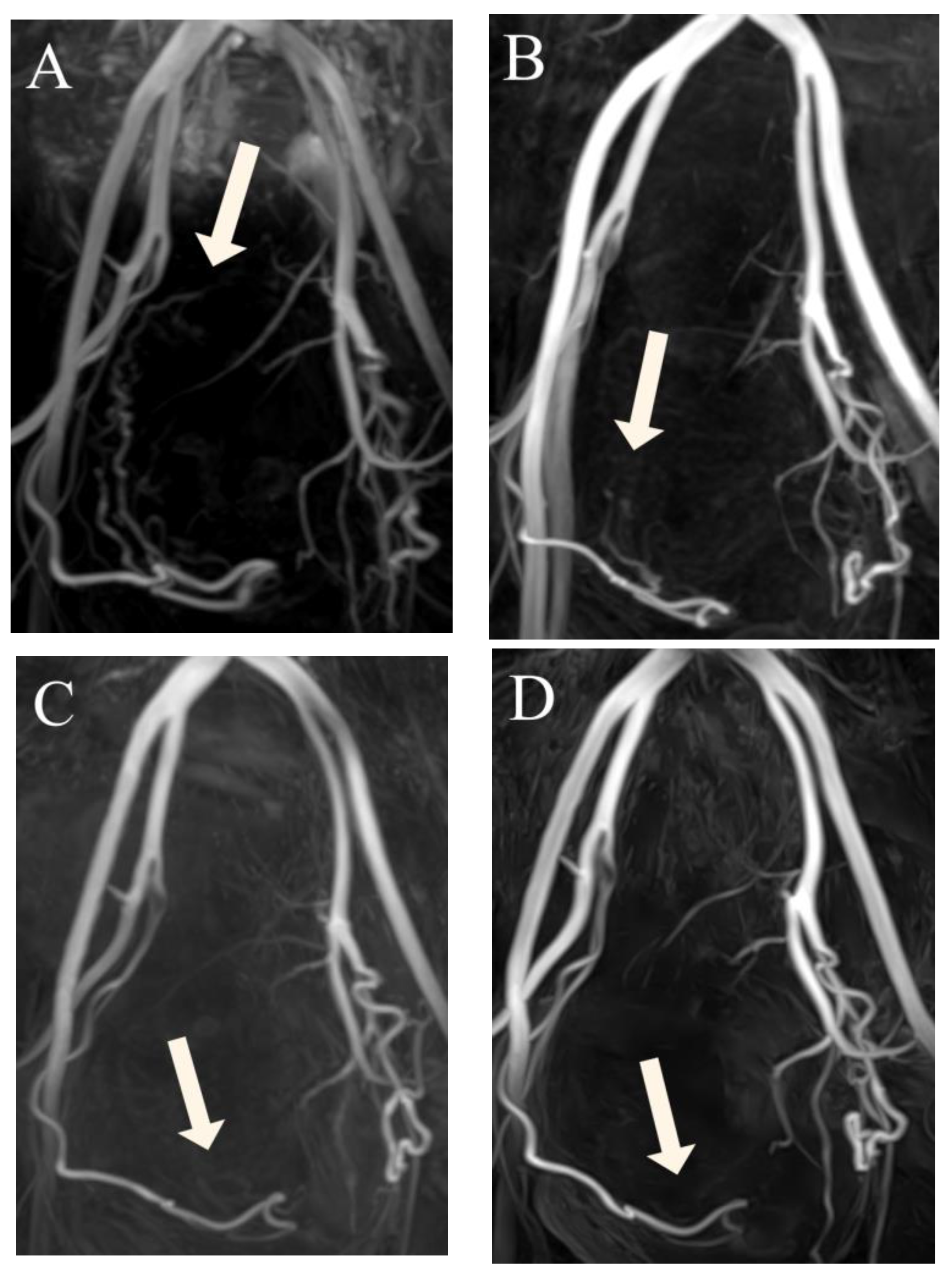 Use of Non-Contrast-Enhanced MR Angiography to Assess Recanalization ...