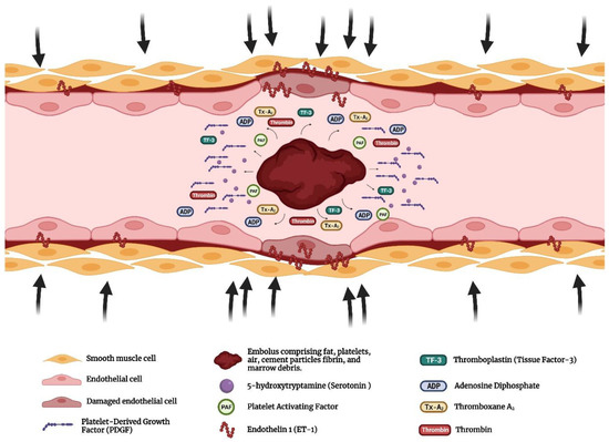 Bone Cement and Its Anesthetic Complications: A Narrative Review