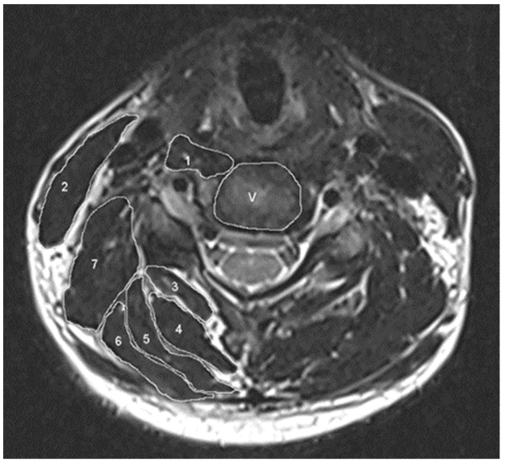 Preoperative Decreased Hounsfield Unit Values of Cervical Vertebrae and ...