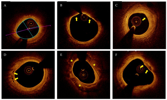 Role of Intracoronary Imaging in Myocardial Infarction with Non ...