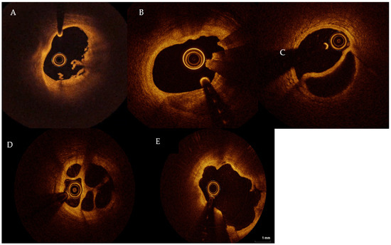 Role of Intracoronary Imaging in Myocardial Infarction with Non-Obstructive Coronary Disease ...
