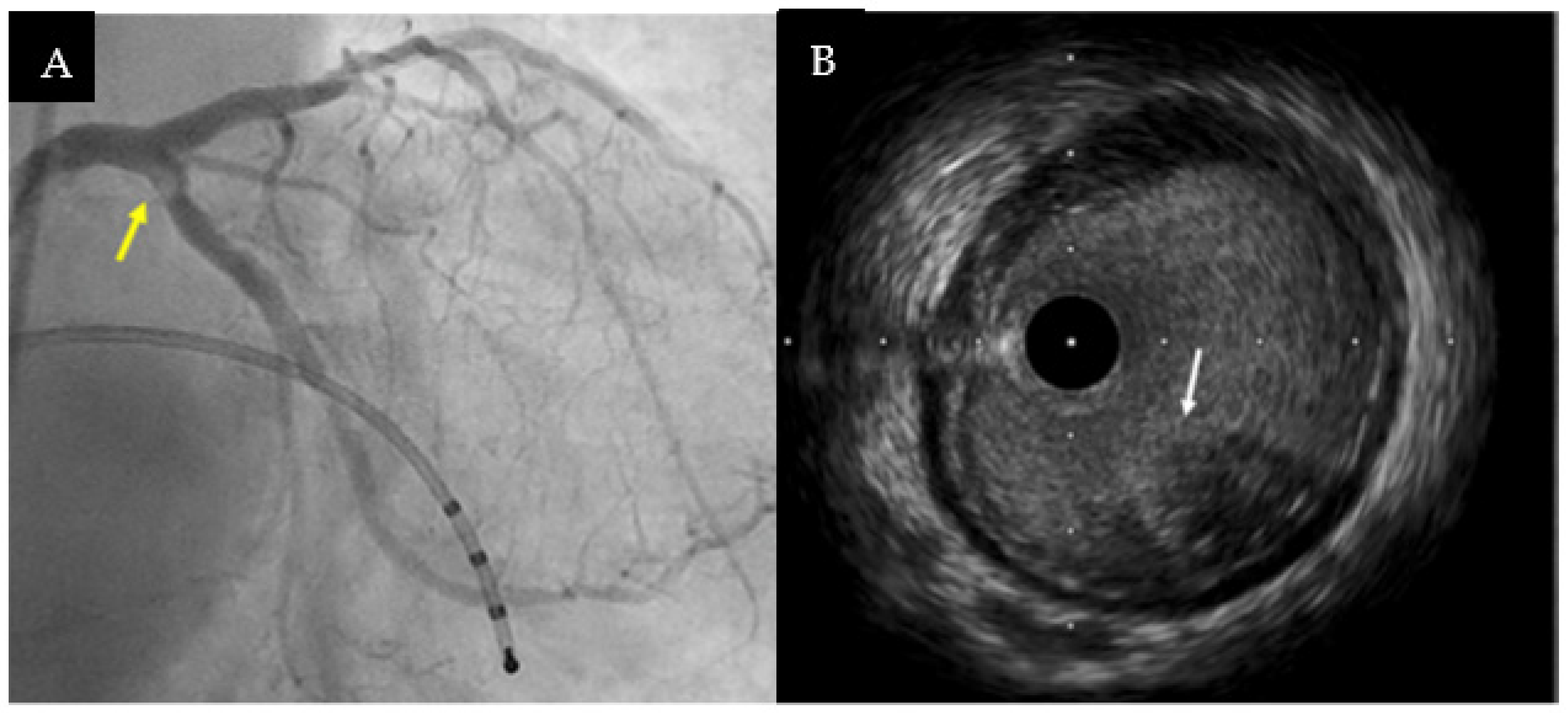Role of Intracoronary Imaging in Myocardial Infarction with Non-Obstructive Coronary Disease ...