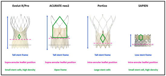 Commissural Alignment and Coronary Access after Transcatheter Aortic ...