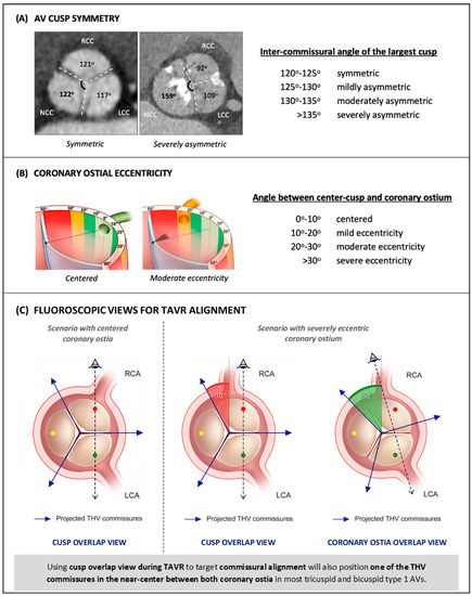 Commissural Alignment and Coronary Access after Transcatheter Aortic Valve Replacement