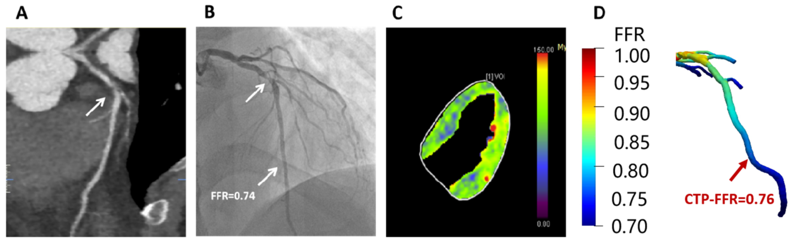 A Novel CT Perfusion-Based Fractional Flow Reserve Algorithm for Detecting Coronary Artery Disease