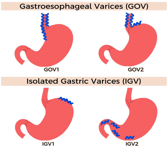 EUS-Guided Vascular Interventions