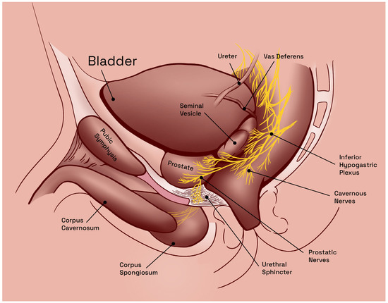 Prostatectomy Diagram