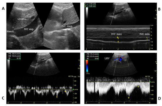 JCM | Free Full-Text | Inferior Vena Cava Ultrasonography for Volume ...