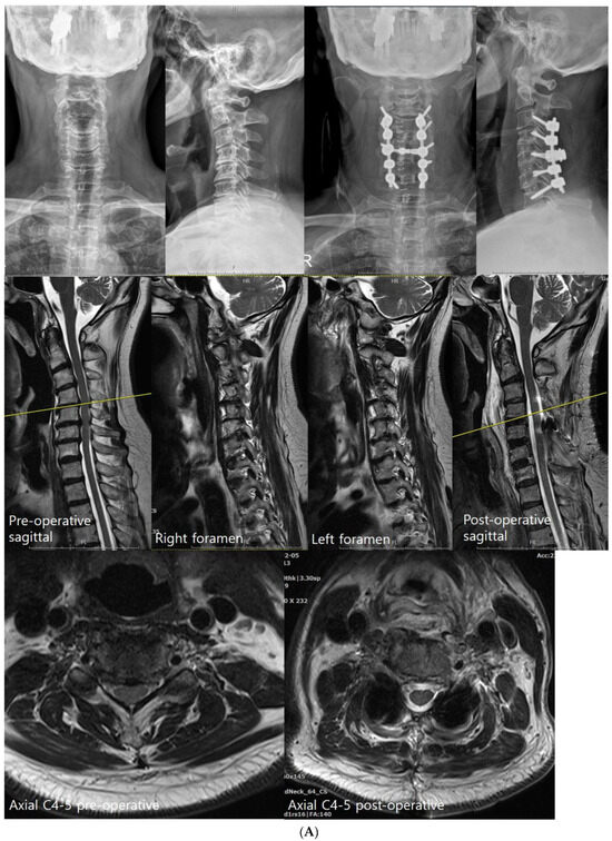 Posterior Preventive Foraminotomy before Laminectomy Combined with ...