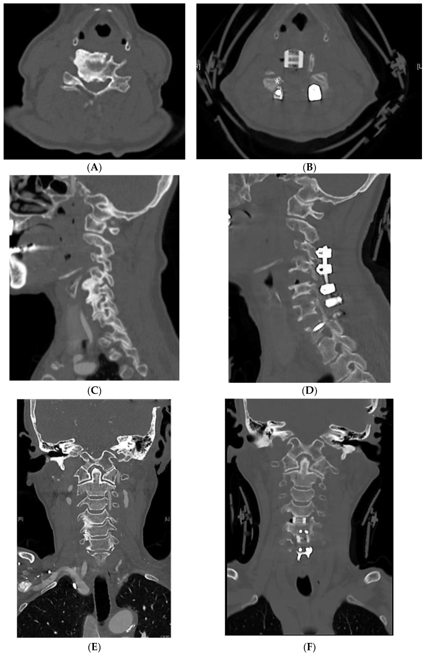 Posterior Preventive Foraminotomy before Laminectomy Combined with ...