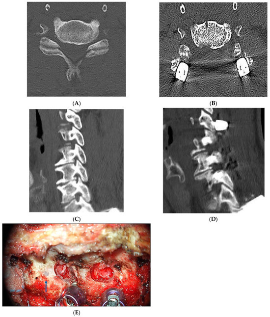 Posterior Preventive Foraminotomy before Laminectomy Combined with ...