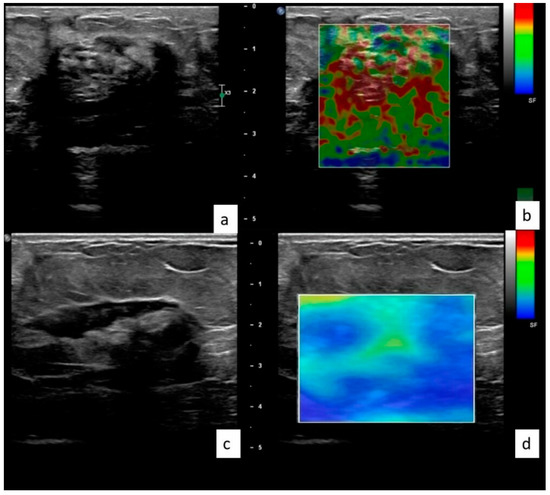Shear Wave Elastography-Correlated Dose Modifying: Can We Reduce ...