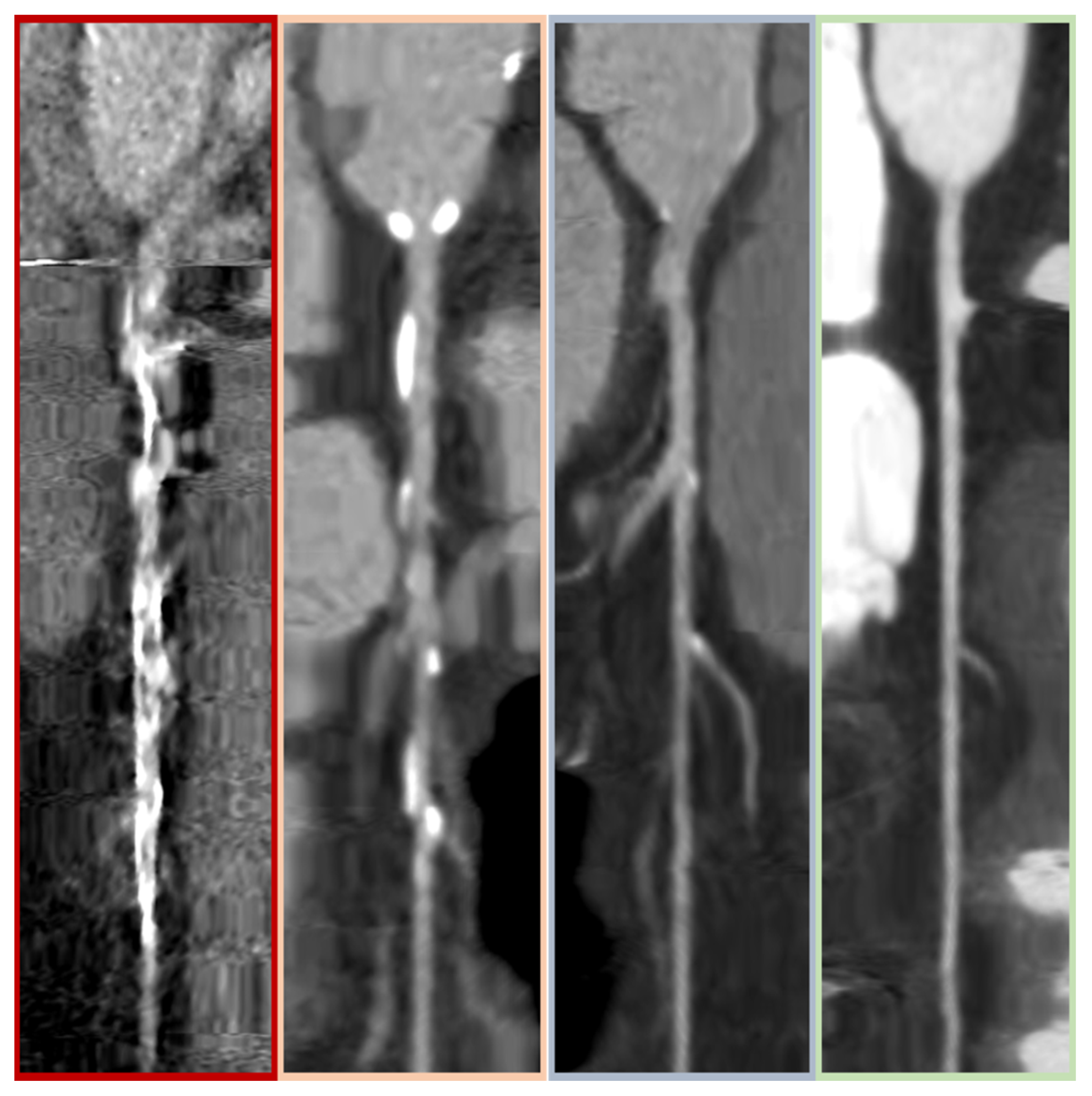 Feasibility of Non-Invasive Coronary Artery Disease Screening with ...