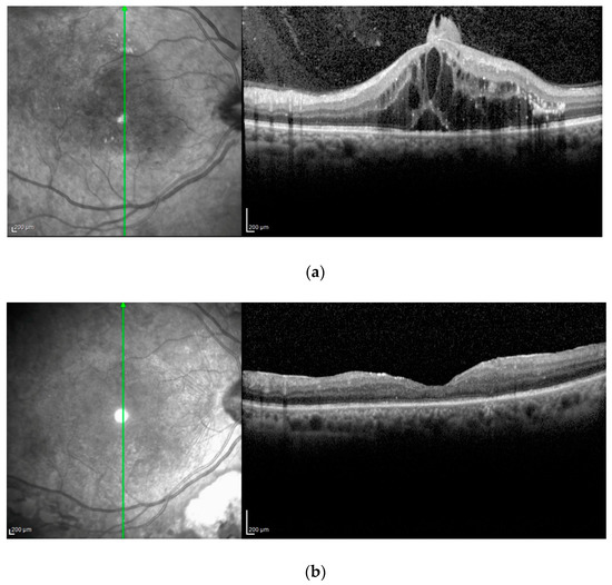Role of Vitrectomy in Nontractional Refractory Diabetic Macular Edema