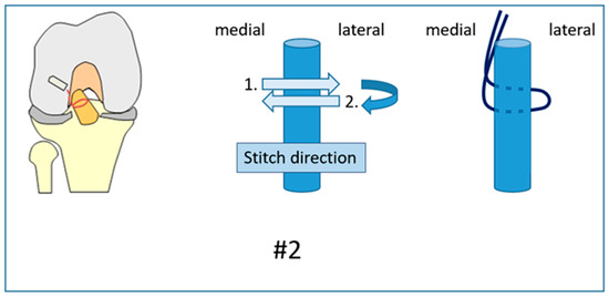 Primary Proximal ACL Repair: A Biomechanical Evaluation of Different ...