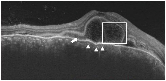 Retinal Pigment Epithelial Characteristics in Acute and Resolved Vogt ...