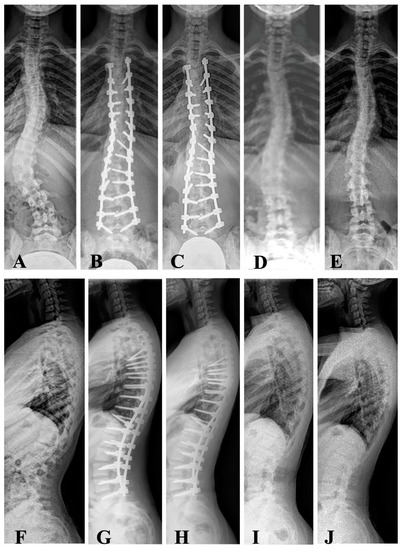Fusionless All-Pedicle Screws for Posterior Deformity Correction in AIS ...
