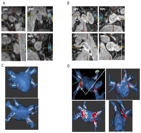 Cryoballoon-Induced Circumferential Pulmonary Vein Fibrosis, Assessed ...