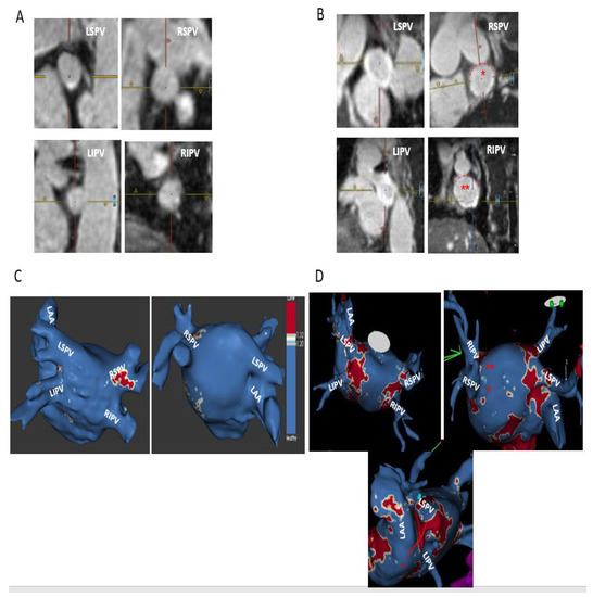 Cryoballoon-Induced Circumferential Pulmonary Vein Fibrosis, Assessed ...