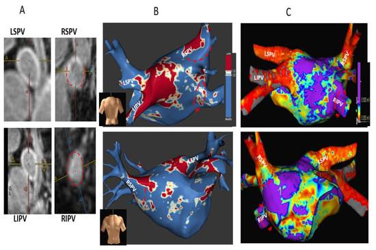 Cryoballoon-Induced Circumferential Pulmonary Vein Fibrosis, Assessed ...