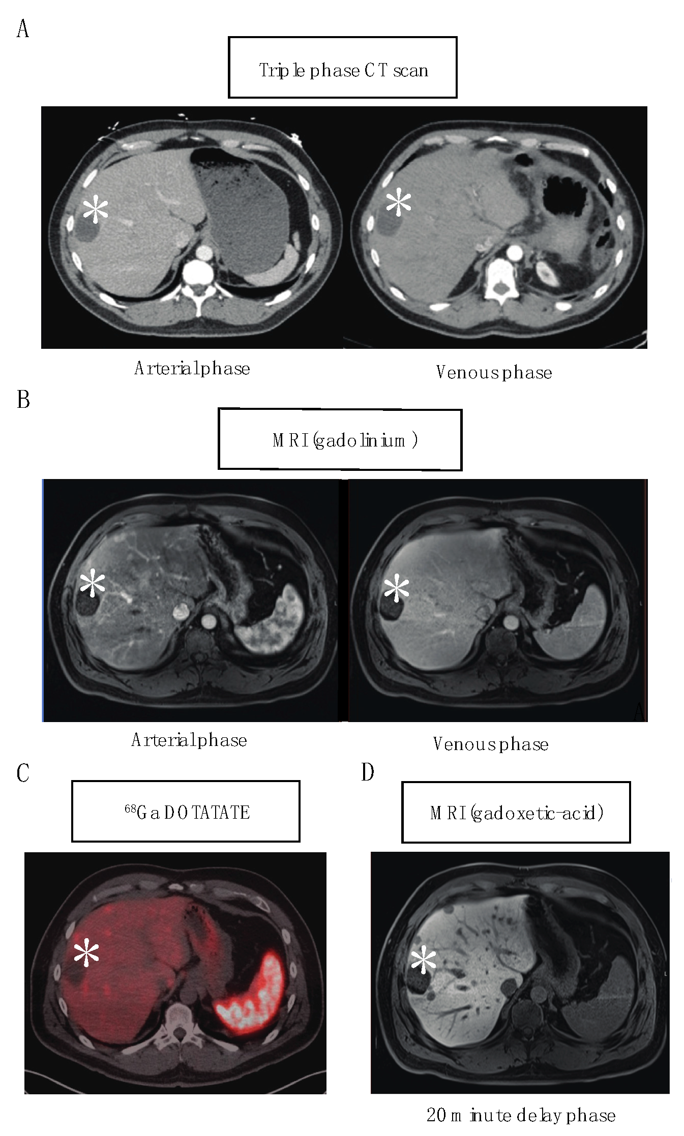 Liver Metastases Ct Scan Hot Sex Picture