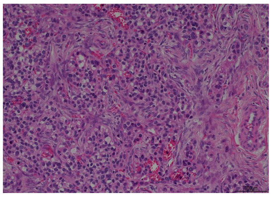A Rare Case of Hepatocellular Carcinoma Recurrence in Ovarian Site ...
