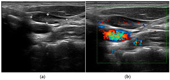 The Dark Side of Ultrasound Imaging in Parathyroid Disease