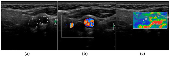 The Dark Side of Ultrasound Imaging in Parathyroid Disease